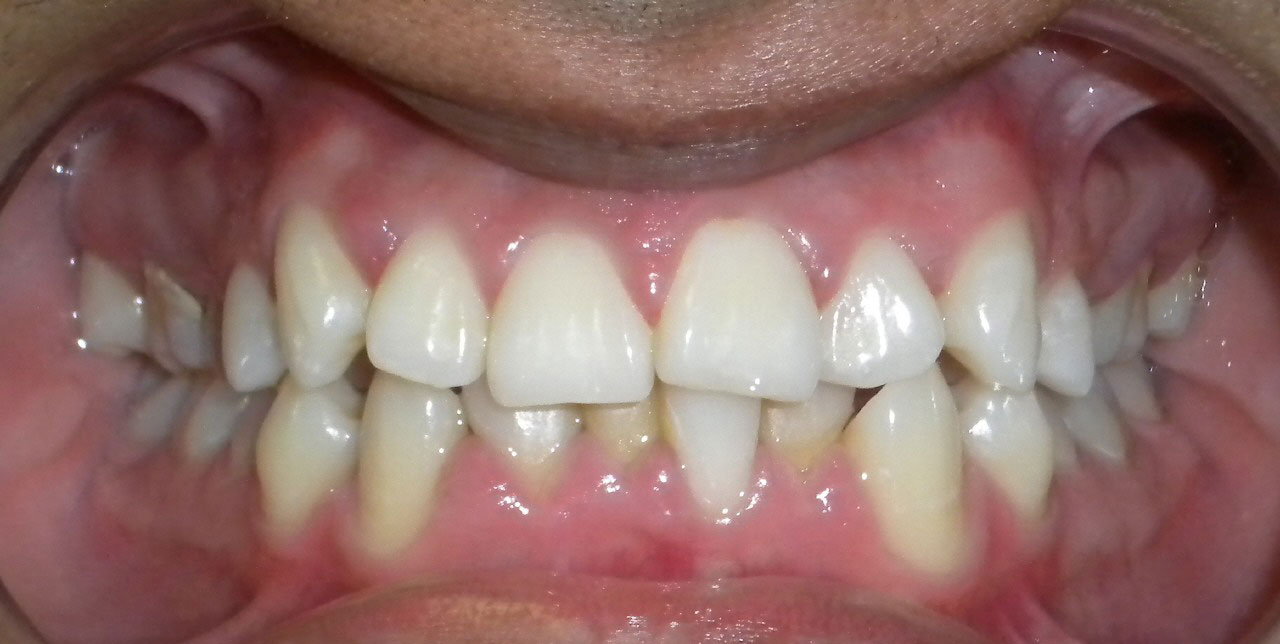 Invisalign® Before & After | Orem, UT | SuperGrin Orthodontics