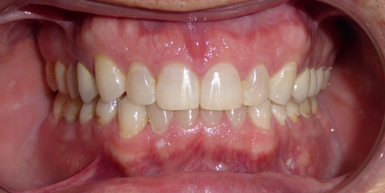 Invisalign® Before & After | Orem, UT | SuperGrin Orthodontics