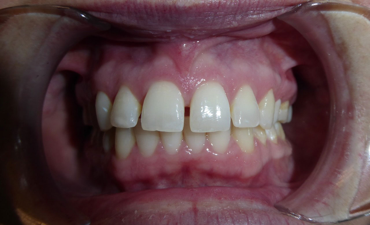 Invisalign® Before & After | Orem, UT | SuperGrin Orthodontics