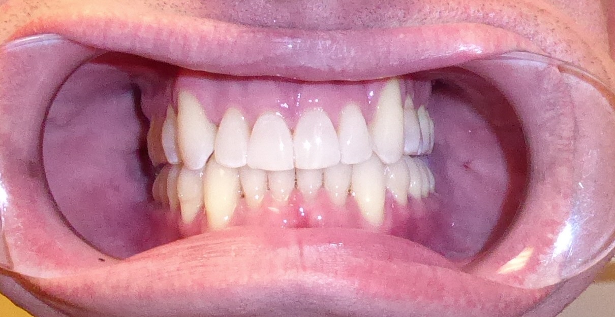 Invisalign® Before & After | Orem, UT | SuperGrin Orthodontics