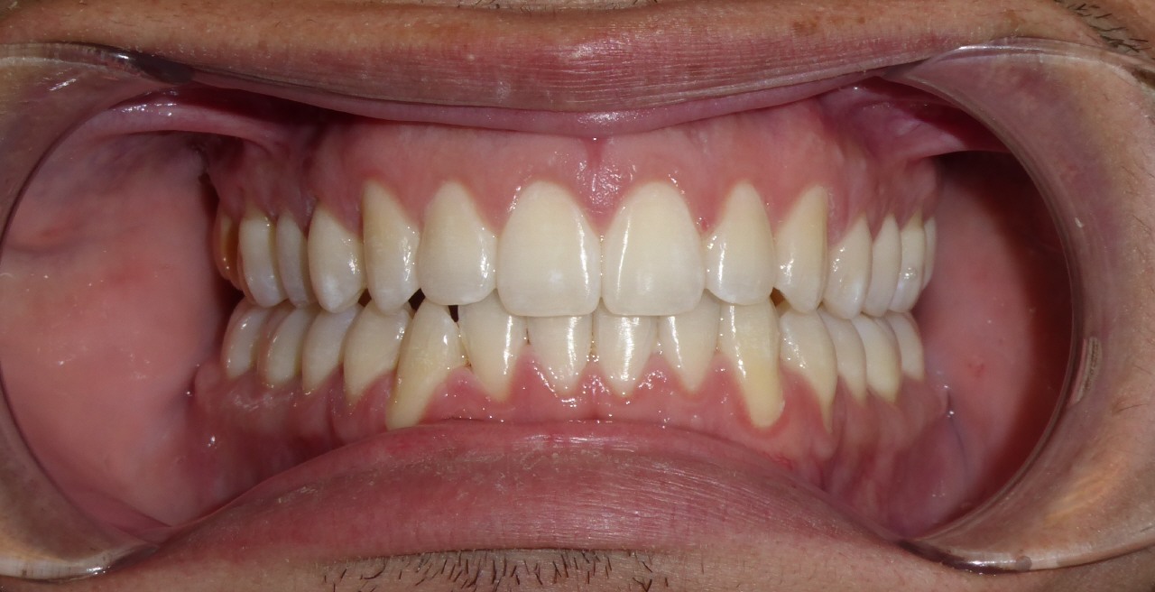 Invisalign® Before & After | Orem, UT | SuperGrin Orthodontics